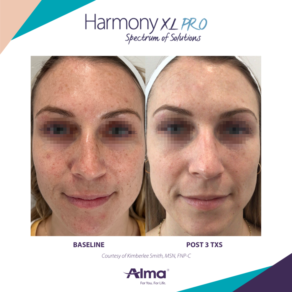 Skin Resurfing – Mediscape