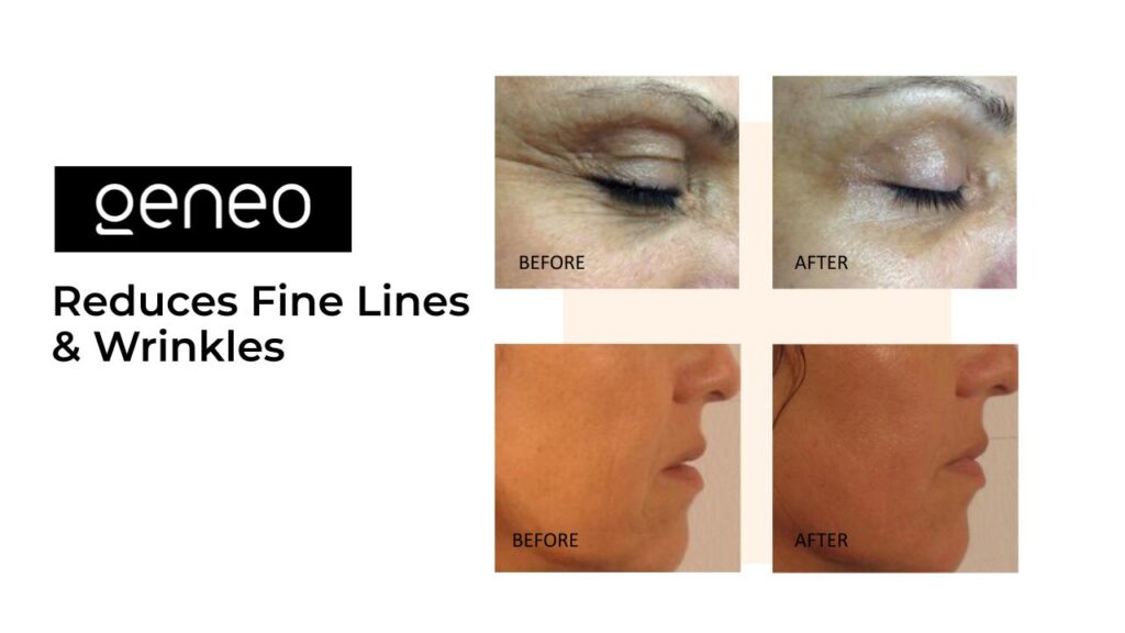 Glo2Facial by Geneo – Mediscape